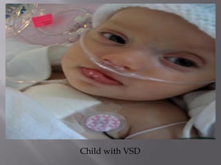 Ventricular Septal Defect with Nursing Management | PDF