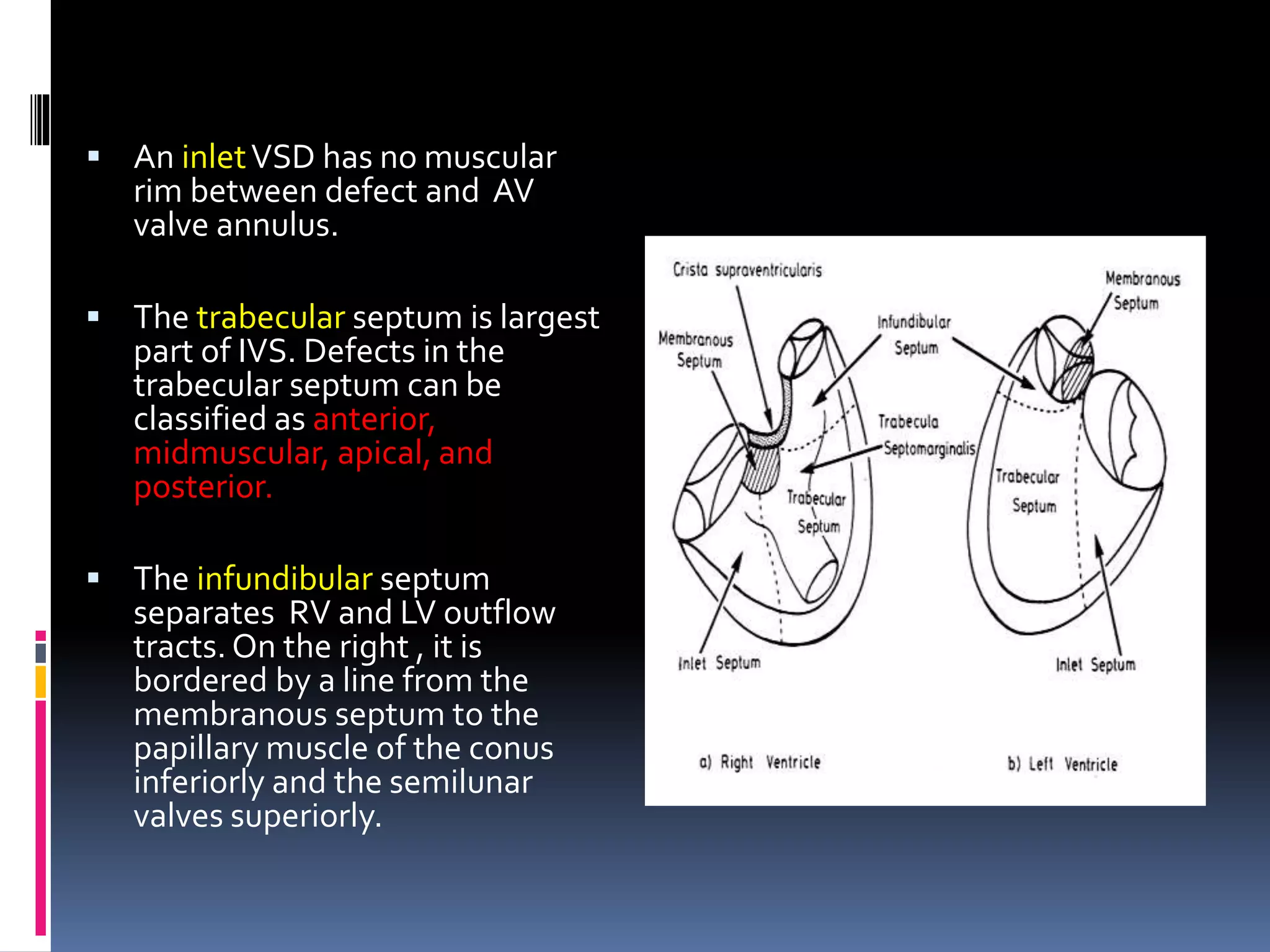 Ventricular Septal Defect | PPTX