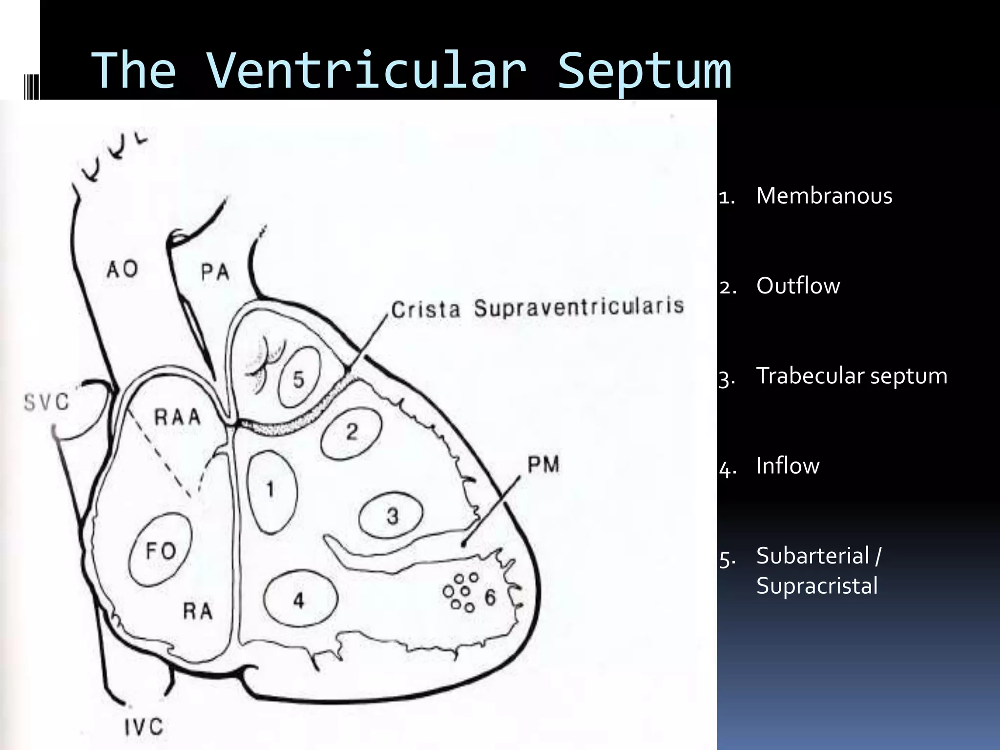 Ventricular Septal Defect | PPTX