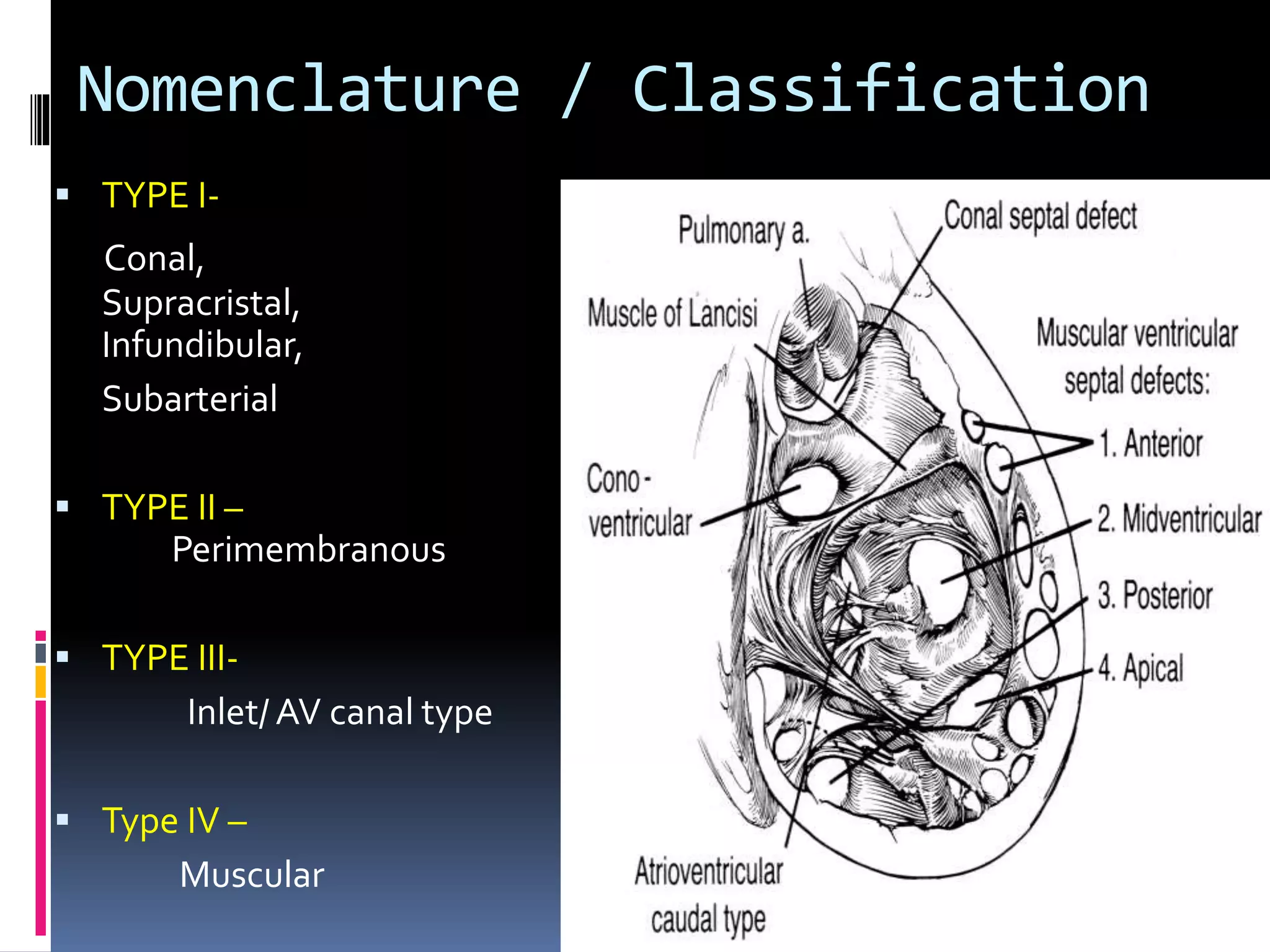 Ventricular Septal Defect | PPTX