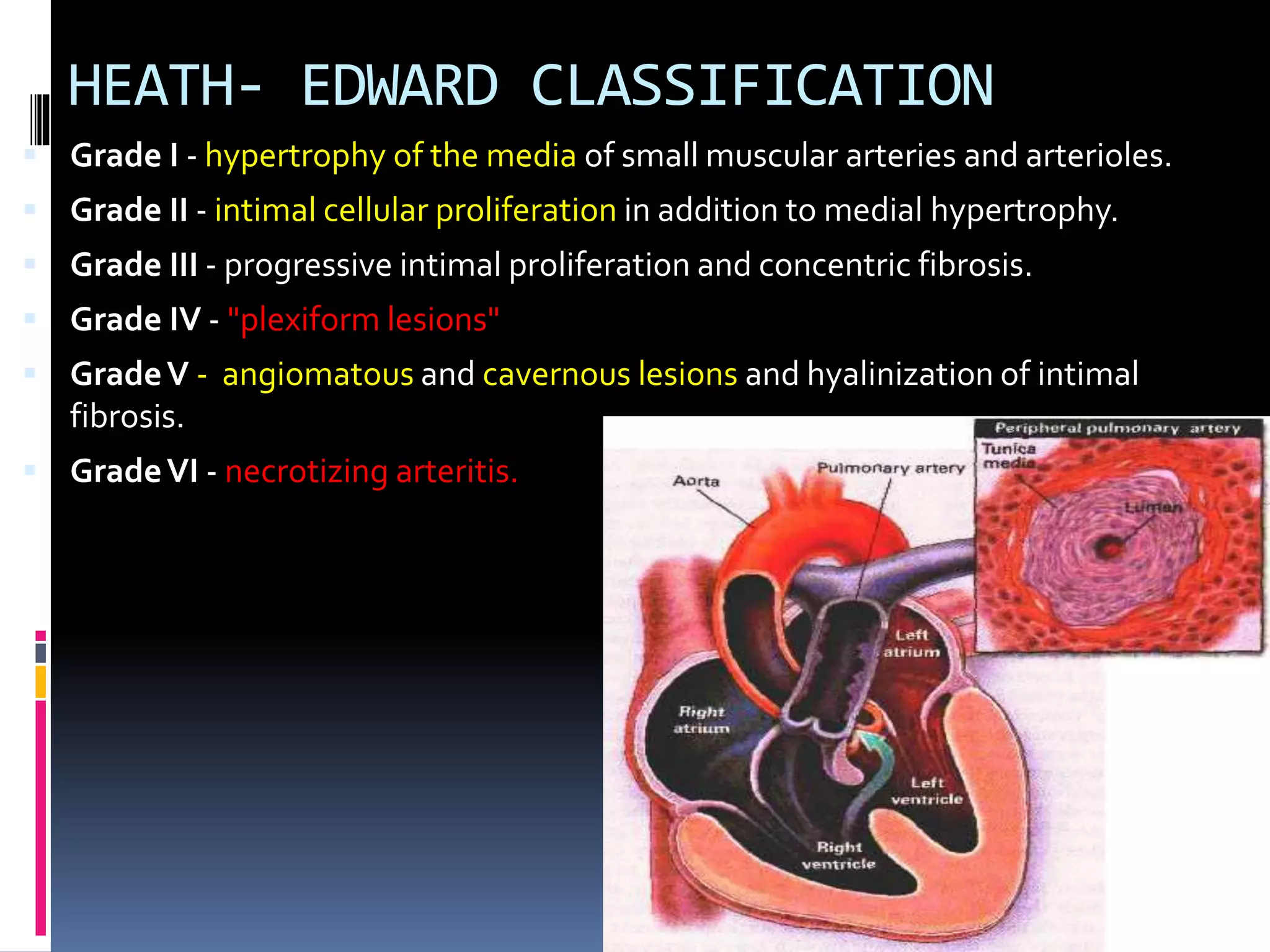Ventricular Septal Defect | PPTX