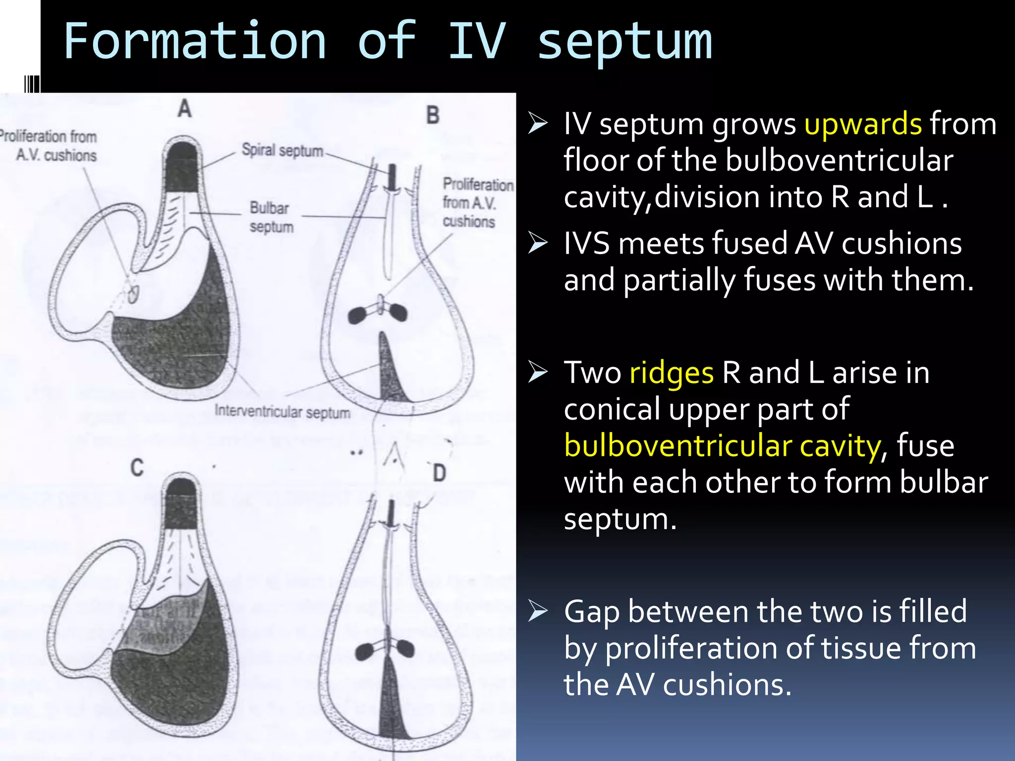 Ventricular Septal Defect | PPTX
