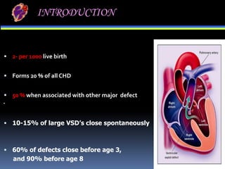 Ventricular Septal Defect | PPTX