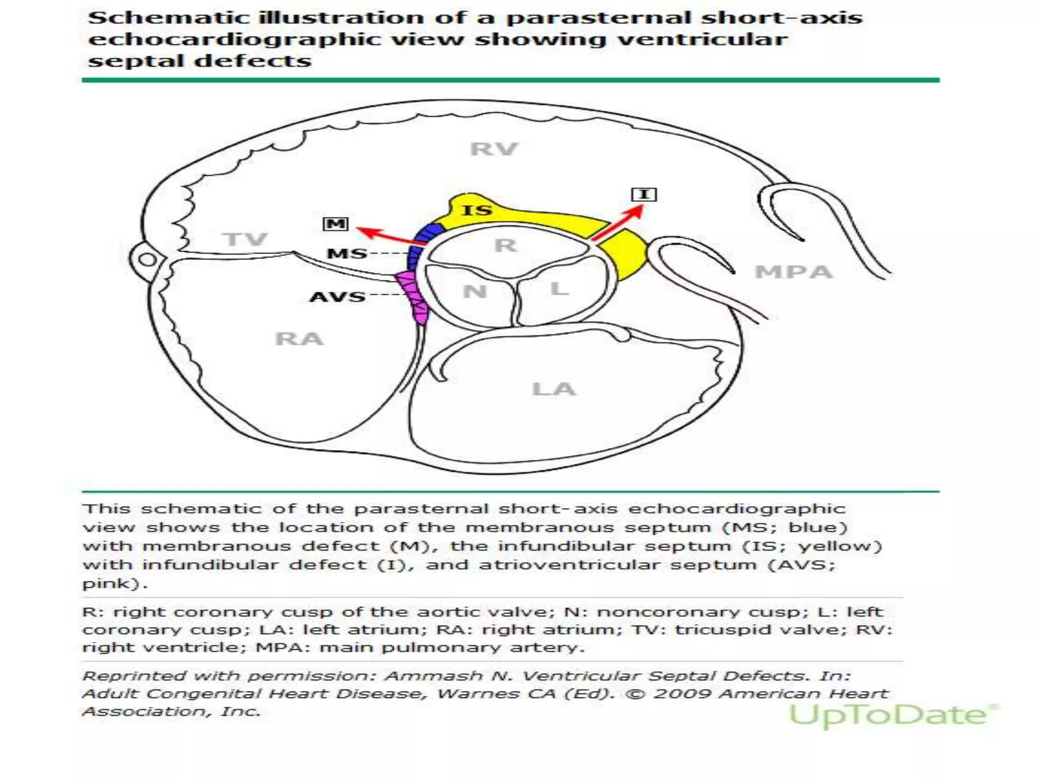 Ventricular Septal defects Echocardiography | PPTX