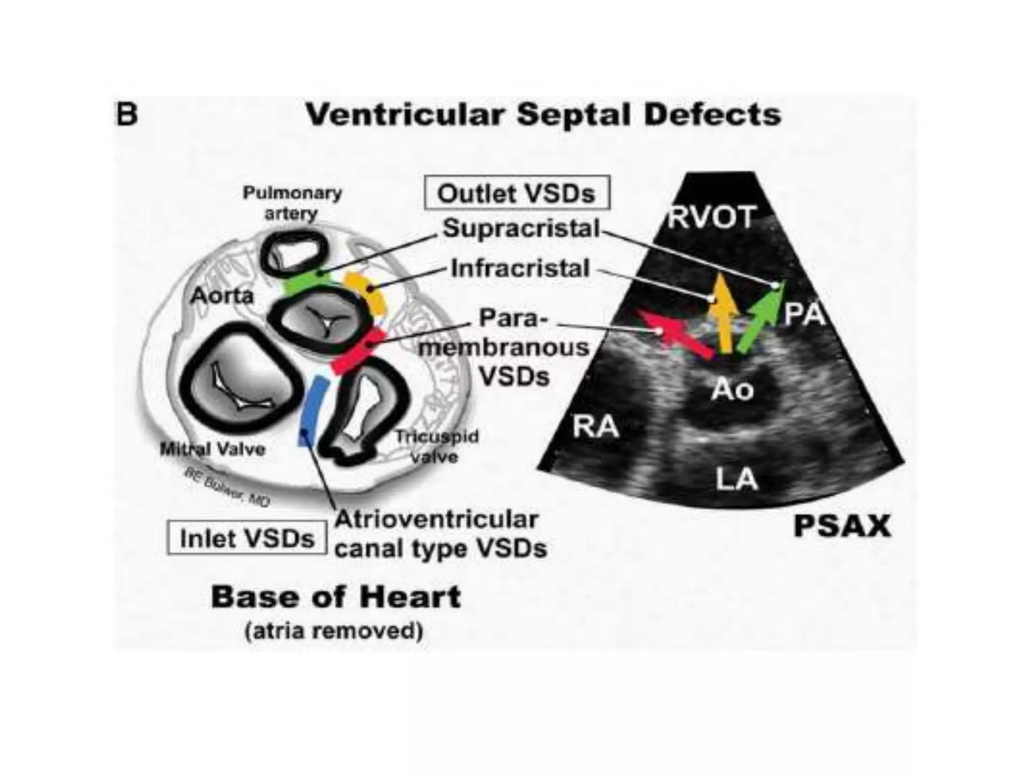 Ventricular Septal defects Echocardiography | PPTX