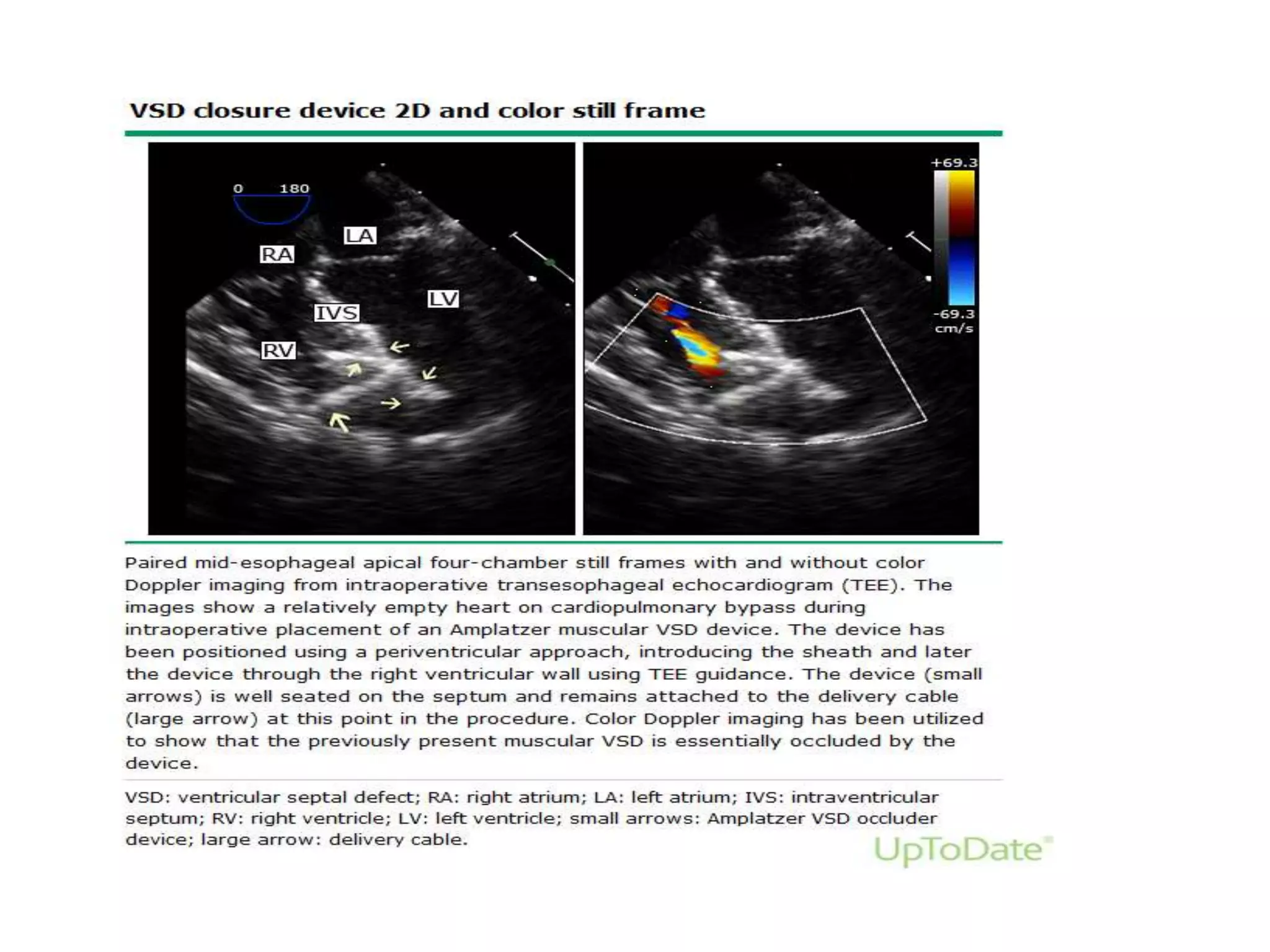 Ventricular Septal defects Echocardiography | PPTX