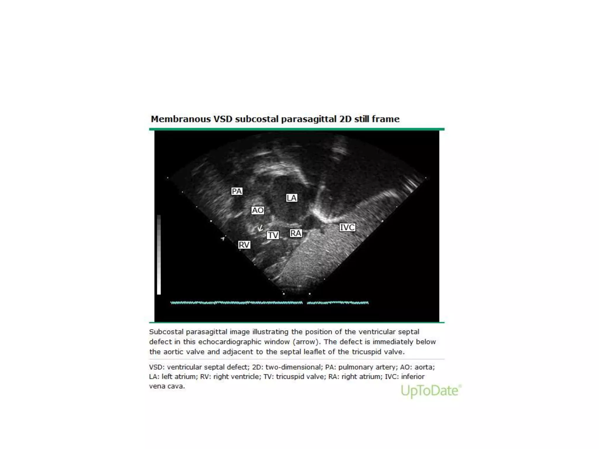 Ventricular Septal defects Echocardiography | PPTX
