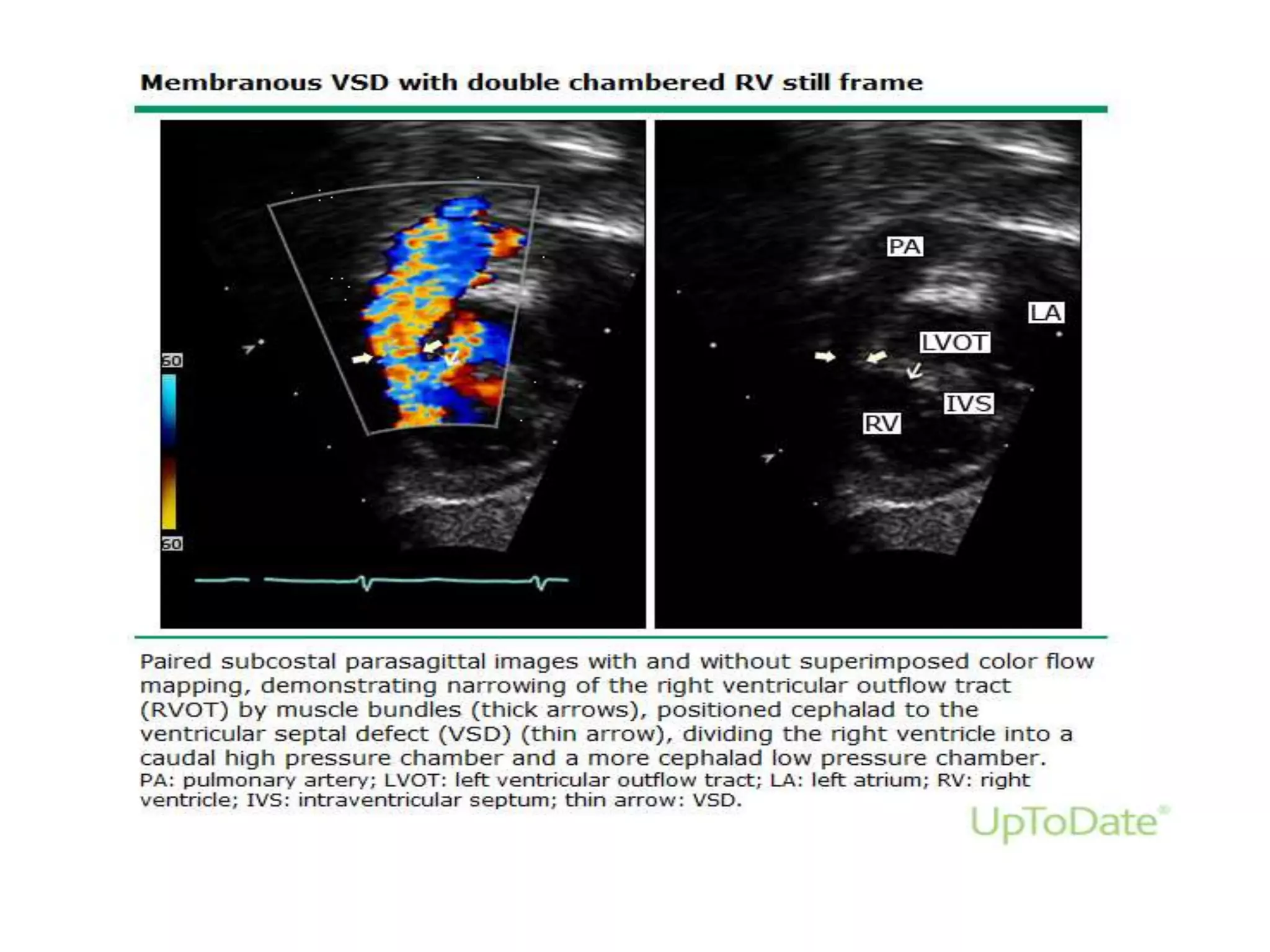 Ventricular Septal defects Echocardiography | PPTX