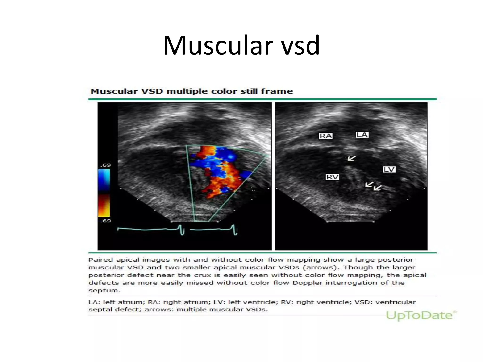 Ventricular Septal defects Echocardiography | PPTX