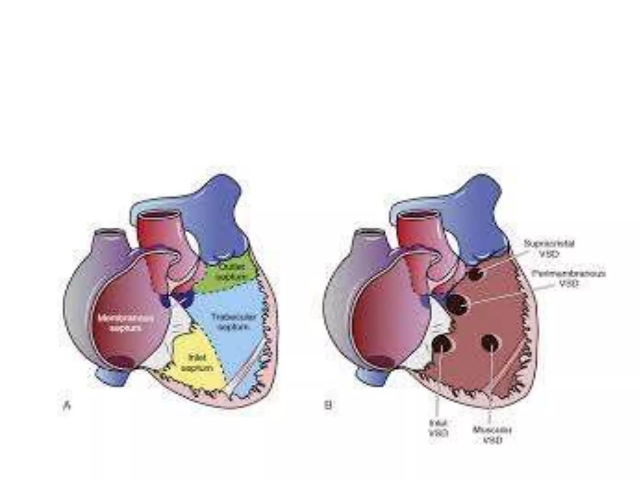Ventricular Septal defects Echocardiography | PPTX