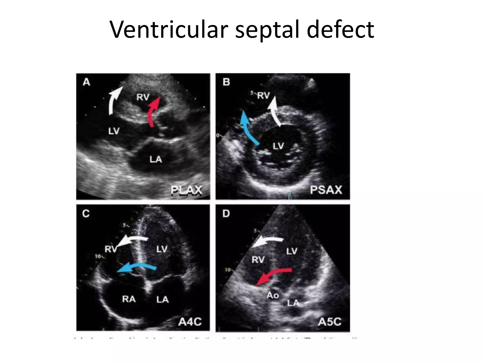 Ventricular Septal defects Echocardiography | PPTX