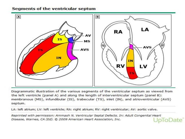 Ventricular Septal defects Echocardiography | PPTX | Heart and Cardiovascular Diseases ...