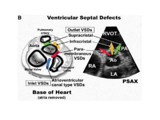 Ventricular Septal defects Echocardiography | PPTX