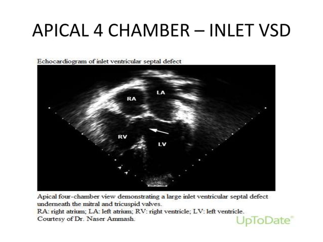 Ventricular Septal defects Echocardiography | PPTX | Heart and Cardiovascular Diseases ...