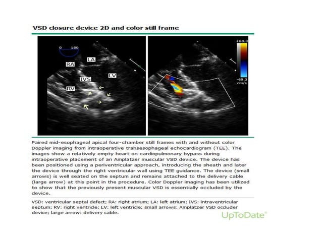 Ventricular Septal defects Echocardiography | PPTX | Heart and Cardiovascular Diseases ...
