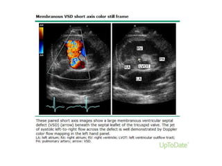 Ventricular Septal defects Echocardiography | PPTX