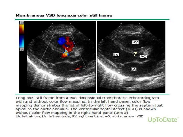 Ventricular Septal defects Echocardiography | PPTX | Heart and Cardiovascular Diseases ...