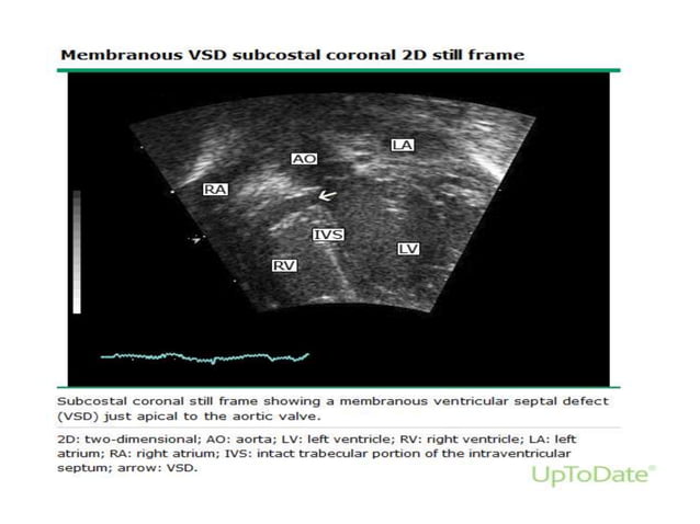 Ventricular Septal defects Echocardiography | PPTX | Heart and Cardiovascular Diseases ...