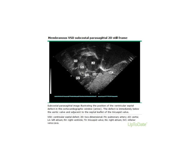 Ventricular Septal defects Echocardiography | PPTX | Heart and Cardiovascular Diseases ...
