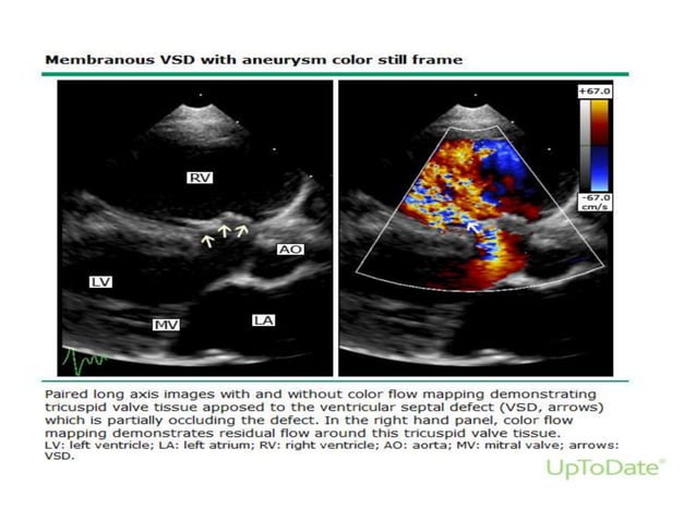 Ventricular Septal defects Echocardiography | PPTX | Heart and Cardiovascular Diseases ...