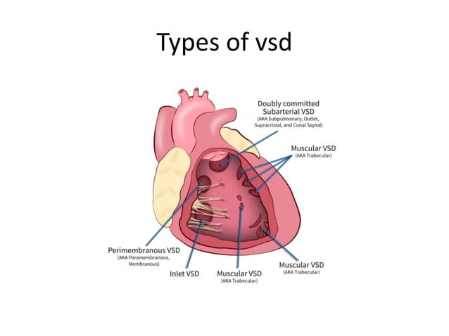 Ventricular Septal defects Echocardiography | PPTX | Heart and Cardiovascular Diseases ...