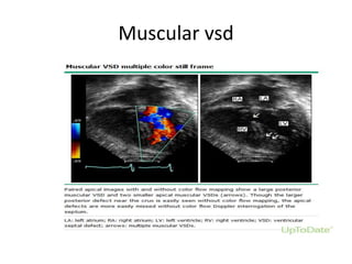 Ventricular Septal defects Echocardiography | PPTX