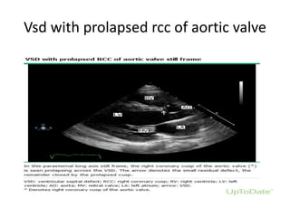 Ventricular Septal defects Echocardiography | PPTX