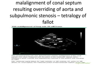 Ventricular Septal defects Echocardiography | PPTX