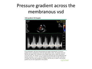 Ventricular Septal defects Echocardiography | PPTX