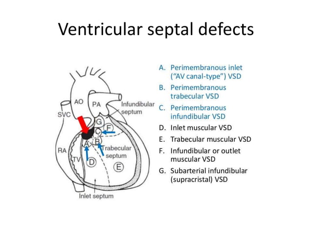 Ventricular Septal defects Echocardiography | PPTX | Heart and Cardiovascular Diseases ...