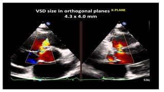 Vsd | PPT
