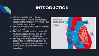 Vsd | PPT