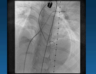 VSD transcatheter closure KACC experience SHA meeting | PPTX