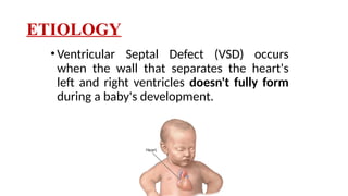 Ventricular septal defect in children.pptx