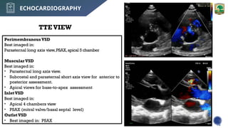 VSD (congenital heart disease explained).pptx