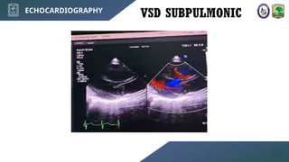 VSD (congenital heart disease explained).pptx