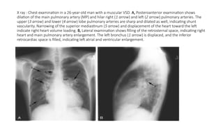 Ventricular septal Defect /Congenital heart defect | PPTX