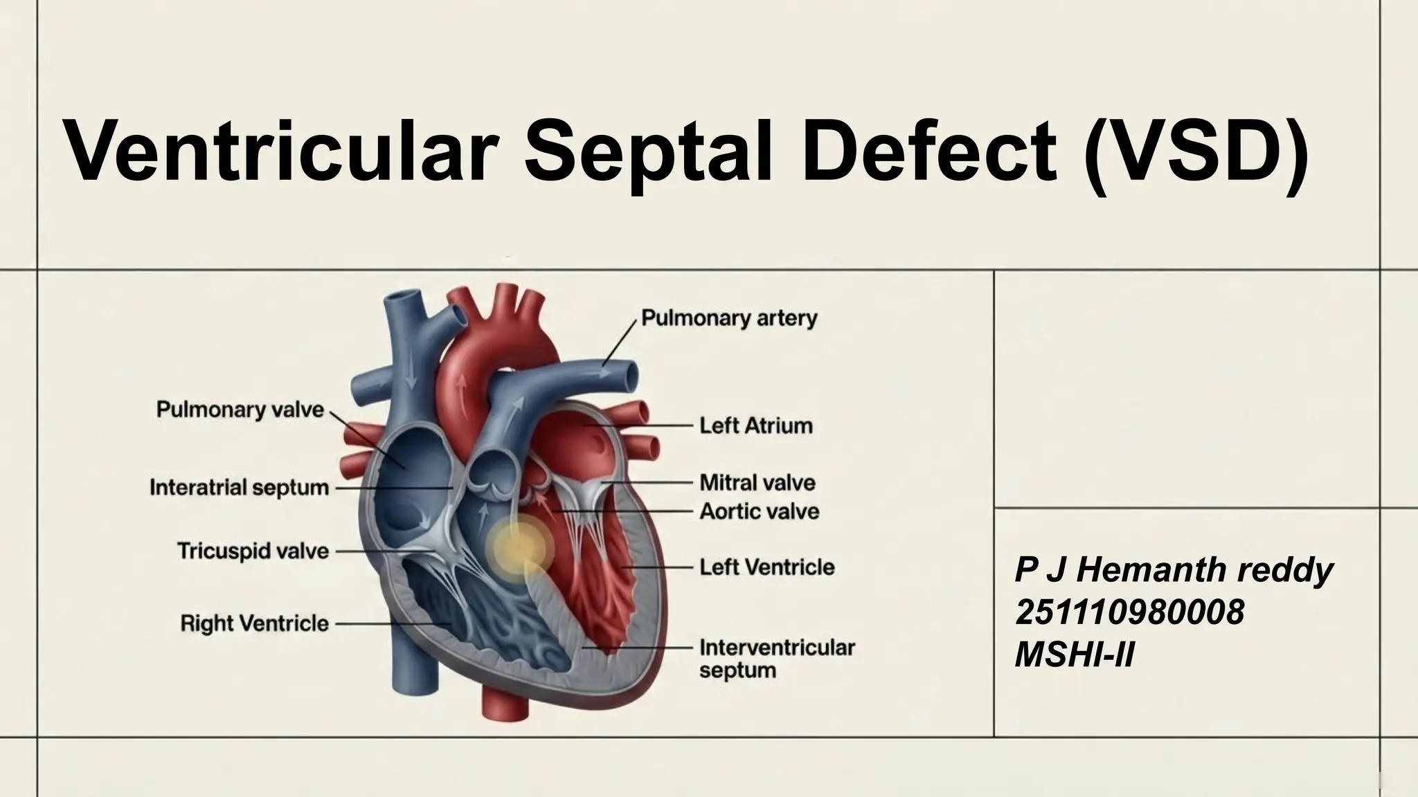 Ventricular Septal Defect in pediatrics.pptx