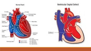 Asuhan keperawatan kardiovaskular ventrikel septal defect (VSD) | PPTX