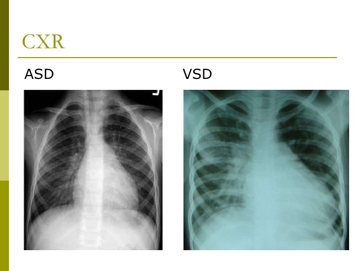 Vsd,Asd &Anaesthesia