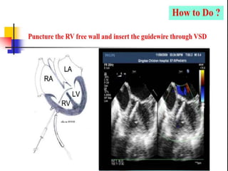 VSD closure Hybride .pptx