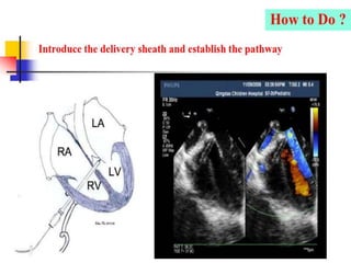 VSD closure Hybride .pptx