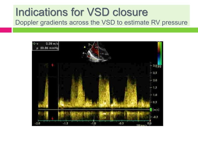 Vsd device closure | PPT