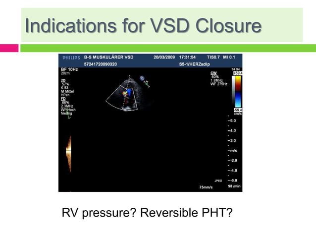 Vsd device closure | PPTX