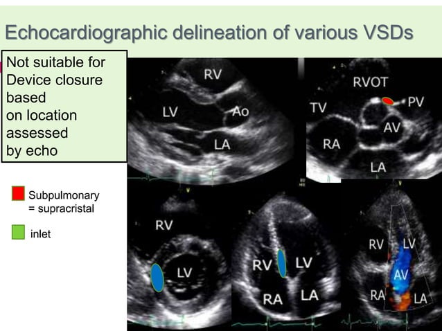 Vsd device closure | PPTX