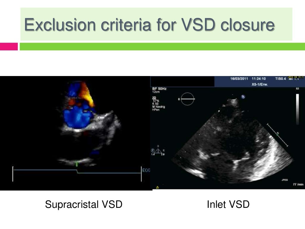 Vsd device closure