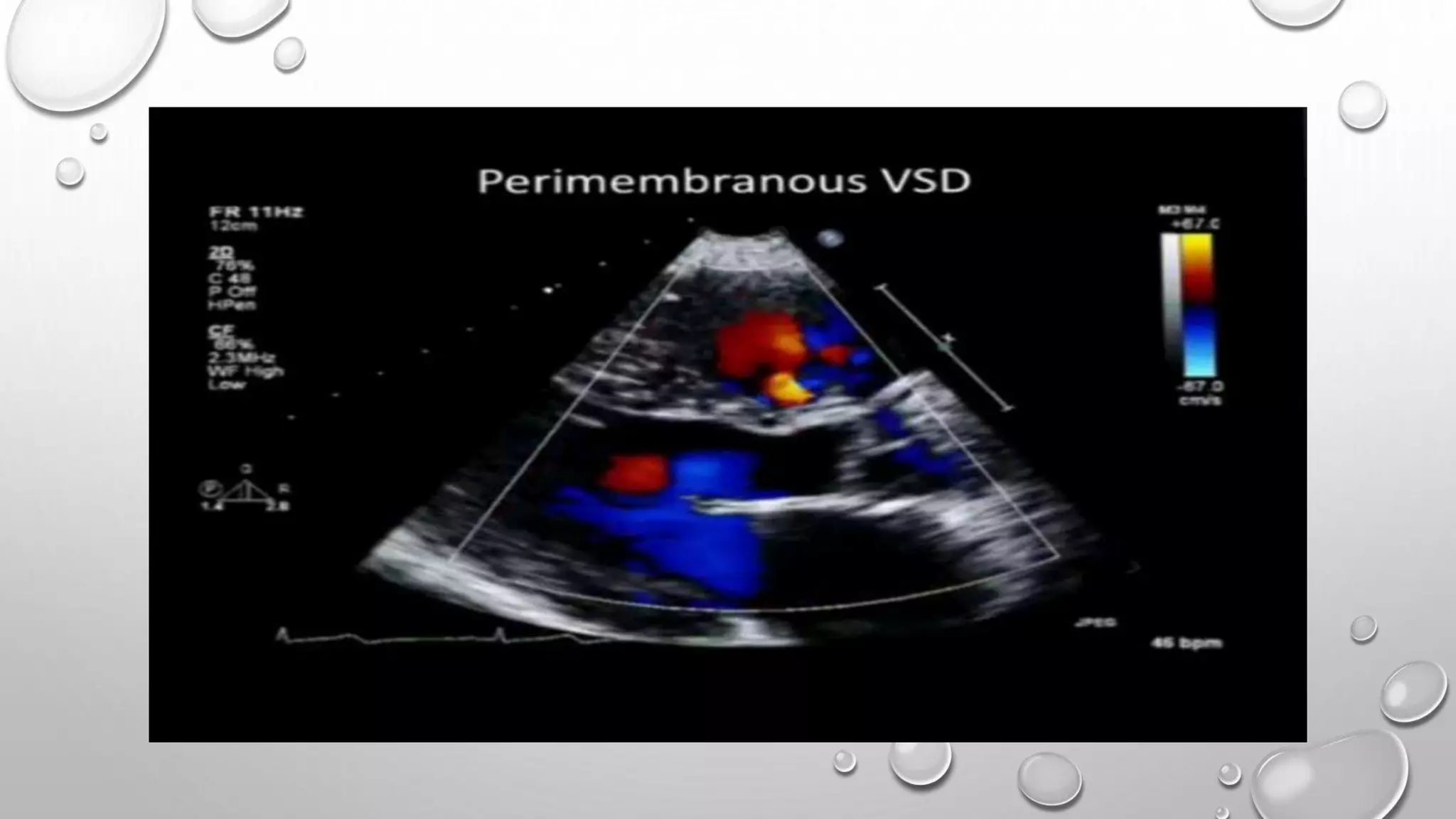 Vsd Echopptx
