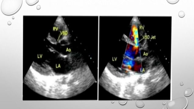 VSD ECHO.pptx | Heart and Cardiovascular Diseases | Diseases and Conditions