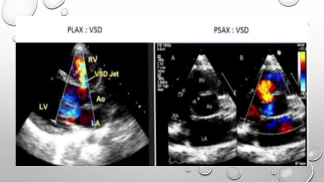 VSD ECHO.pptx | Heart and Cardiovascular Diseases | Diseases and Conditions