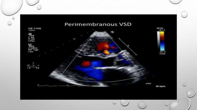 VSD ECHO.pptx | Heart and Cardiovascular Diseases | Diseases and Conditions